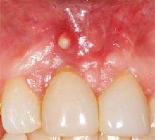 🦷 La cisti dentale: diverse tipologie e come curarla 🦷