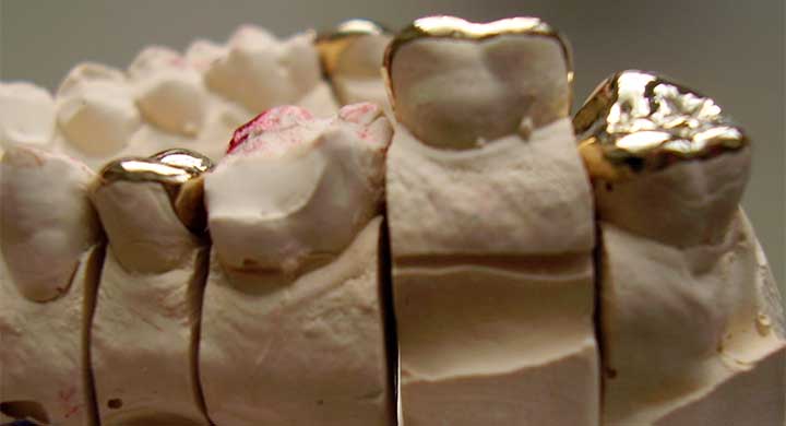 Intarsi dentali Onlay/Inlay/Overlay per carie 🦷: guida completa