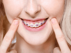 Attachment Invisalign, cosa sapere sul bottone ortodontico