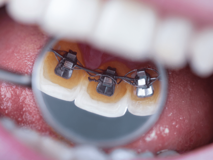 Ortodonzia: apparecchio dentale per adulti, costo 💰 e durata