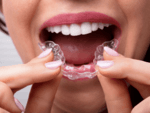Apparecchio invisibile costo e info su Invisalign e linguale