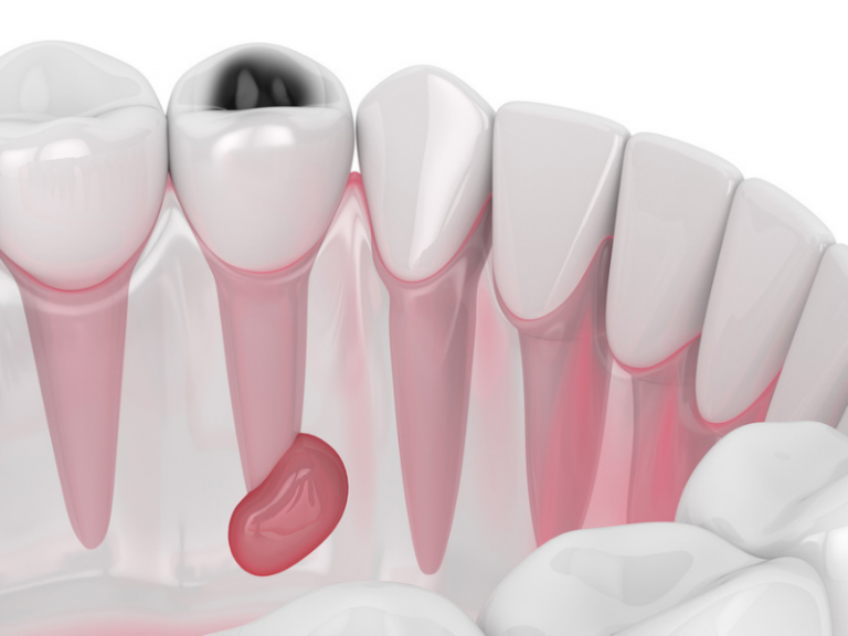 🧴 Ulcere in bocca o afte: cause, rimedi e prevenzione 🧴;