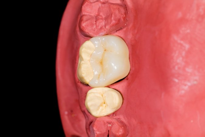 👩‍⚕️ Dente scheggiato o rotto: costo, cause, trattamenti 👩‍⚕️