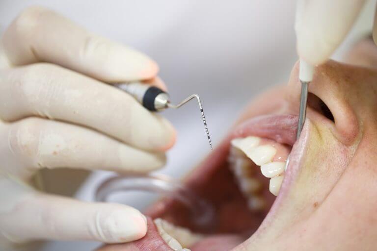 Cura laser per la parodontite: informazioni sul trattamento