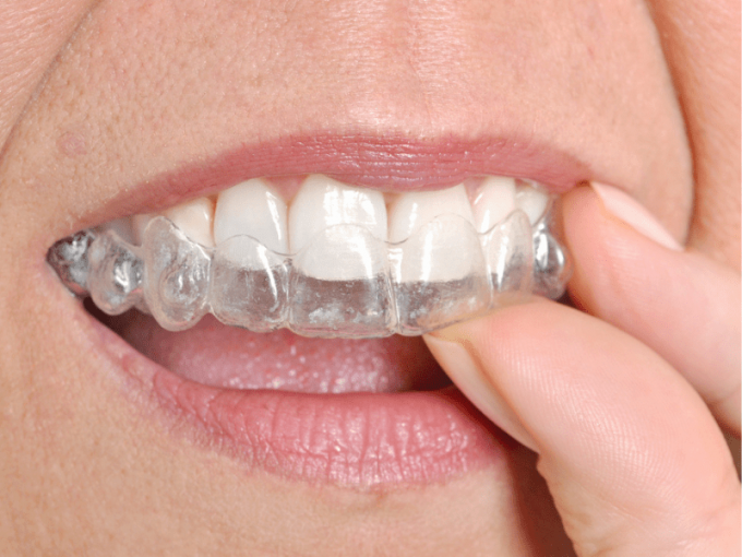 Invisalign dolore 🤕 Cosa fare quando Invisalign fa male