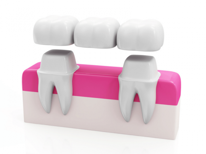Intarsi dentali Onlay/Inlay/Overlay per carie 🦷: guida completa