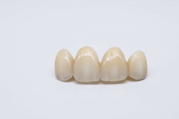 Ponte dentale provvisorio: soluzione prima del ponte fisso