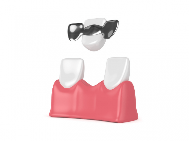 ️ Ponte dentale mobile: caratteristiche, costo e vantaggi ️