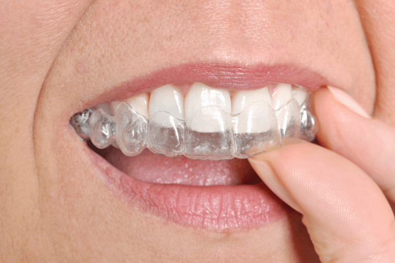 🔵 Attachment Invisalign, guida su attacchi o ganci Invisalign 🔵