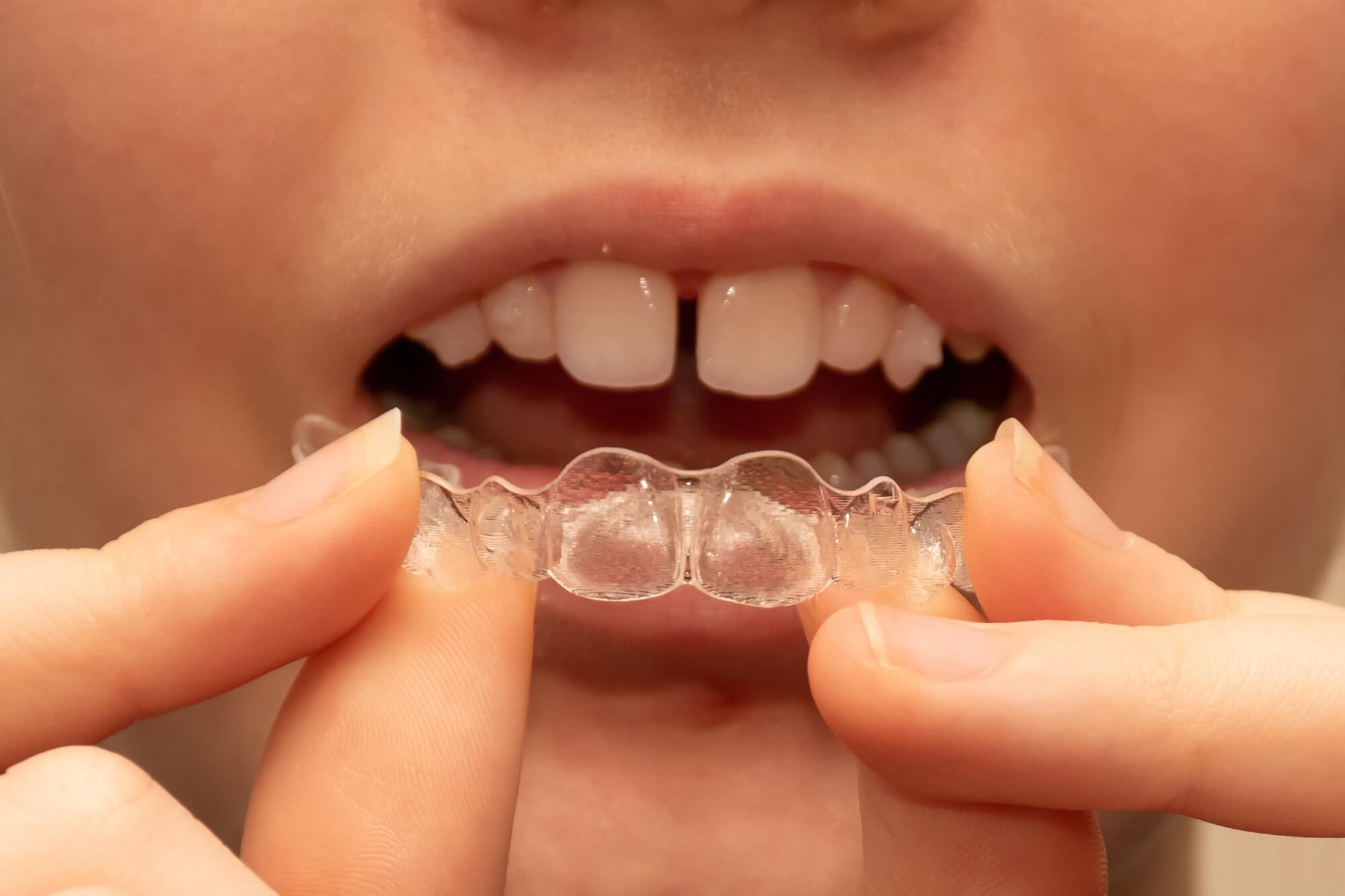 🔵 DR SMILE o Invisalign: Quale è meglio? 🔵