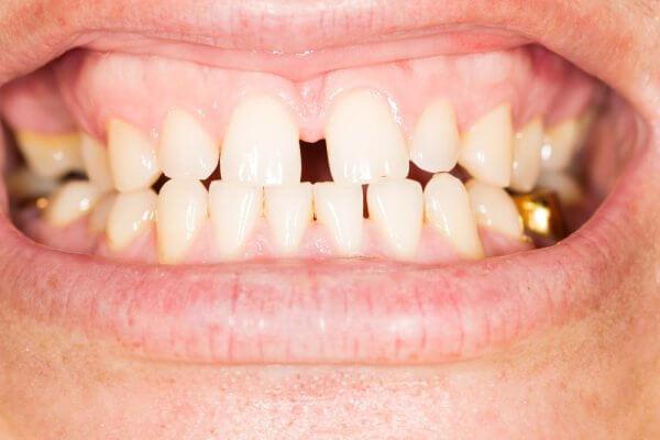 Malocclusione dentale: cos'è, prevenzione e trattamenti;