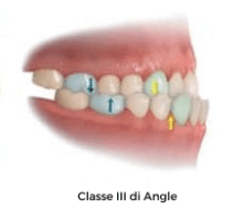 Malocclusione 3 Classe: sinotimi, cause, trattamento