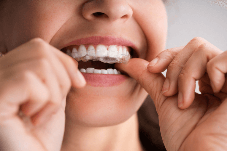 Spark o Invisalign: che marca di ortodonzia è migliore?
