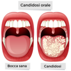 Candida orale: sintomi, immagini, cura e come si contagia
