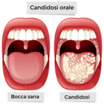 Candida orale: sintomi, immagini, cura e come si contagia