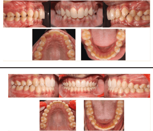 Invisalign Prima e Dopo: 👈👉 Casi di Ortodonzia Invisibile