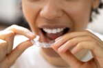 🔵 Attachment Invisalign, guida su attacchi o ganci Invisalign 🔵