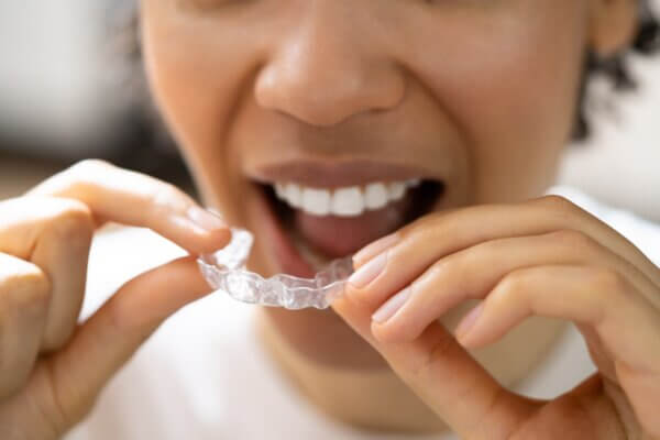 🔵 Attachment Invisalign, guida su attacchi o ganci Invisalign 🔵